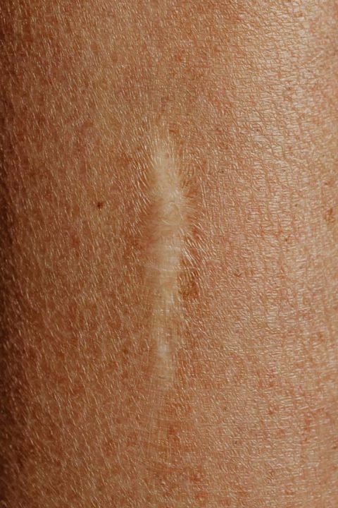 Surgical Scar | Alomar Health